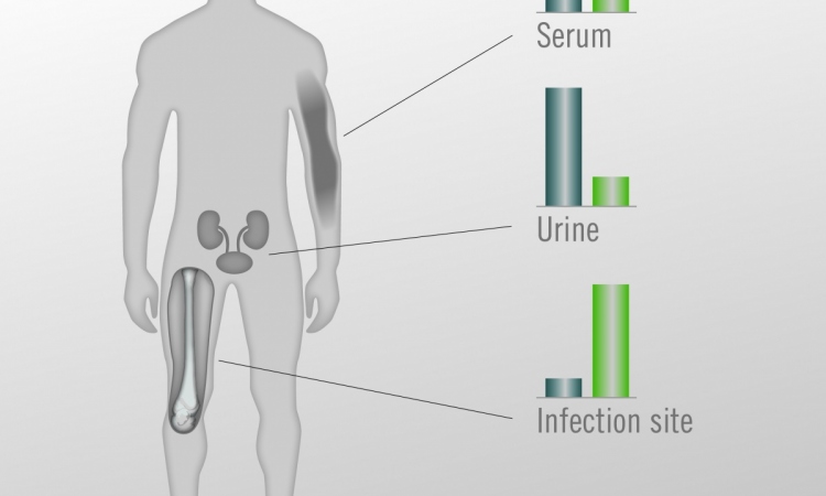 Painful knee prosthesis: loose, infected or both? • healthcare-in ...