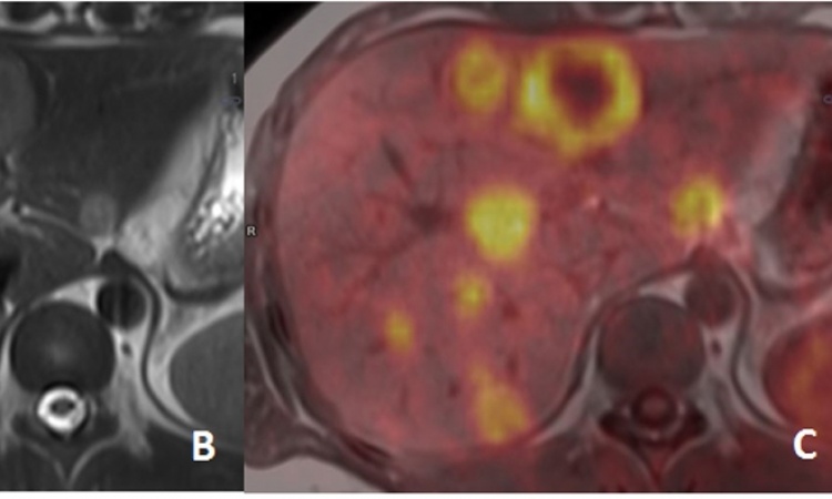 Raising the bar higher in CRC imaging • healthcare-in-europe.com