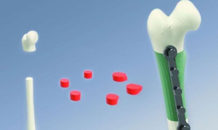 Advancing technique for of personalied bone grafts • healthcare-in ...