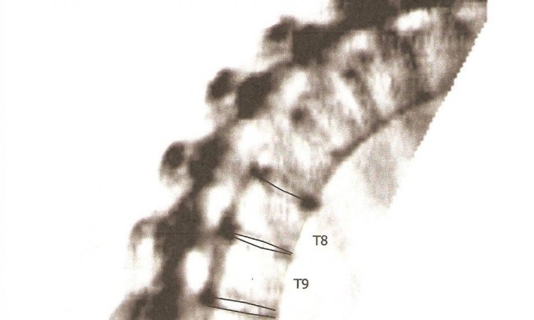 Understanding Bechterew's disease • healthcare-in-europe.com