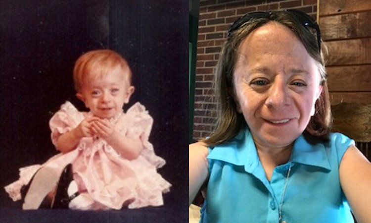 Cause of rare type of dwarfism discovered • healthcare-in-europe.com