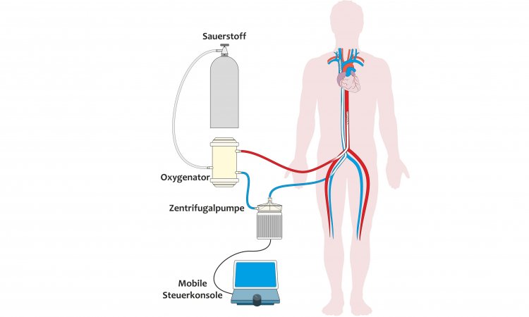 Herz-Lungen-Maschine: Vom 200-Kilo-Gerät zur mobilen Notfallversion ...