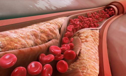 Giving patients a say in vascular conditions research • healthcare-in ...