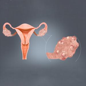 “Words matter” when diagnosing women with polycystic ovary syndrome ...