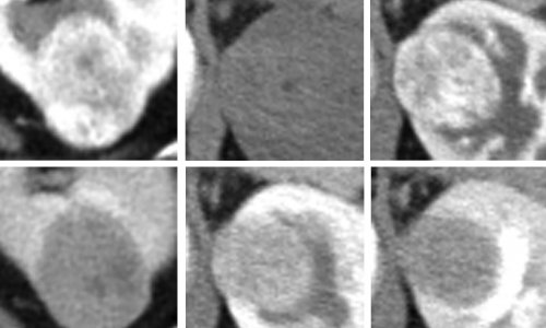 Algorithm differentiates small renal masses on multiphase CT ...