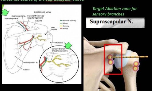 Novel technique 'stuns' arthritis pain in shoulder • healthcare-in ...