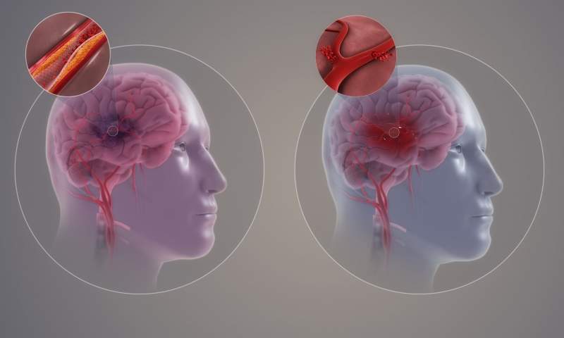 How blood vessels 'remember' a stroke • healthcare-in-europe.com
