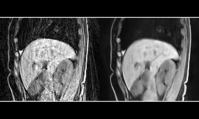 Deep learning method boosts MRI results without new data • healthcare ...