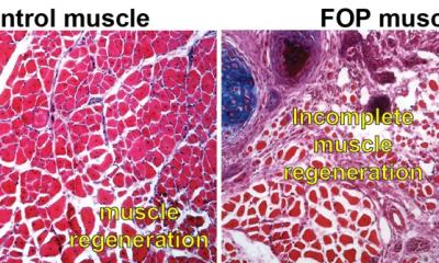 FOP: Origin of rare disease • healthcare-in-europe.com