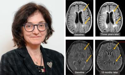 Uncovering the hidden part of the WMH iceberg • healthcare-in-europe.com