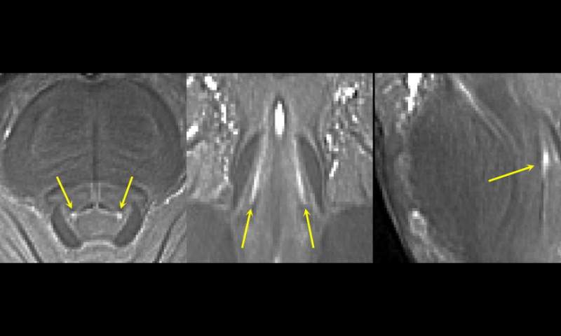 Parkinson's: Misconception of 'swallow-tail'-sign rectified ...