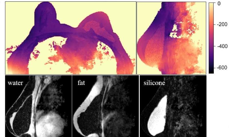 Predicting atrial fibrillation with MRI • healthcare-in-europe.com