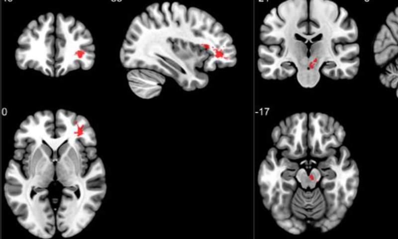 Parkinson's: Misconception of 'swallow-tail'-sign rectified ...