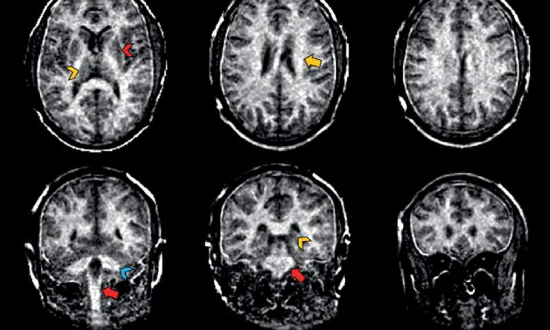 Parkinson's: Misconception of 'swallow-tail'-sign rectified ...