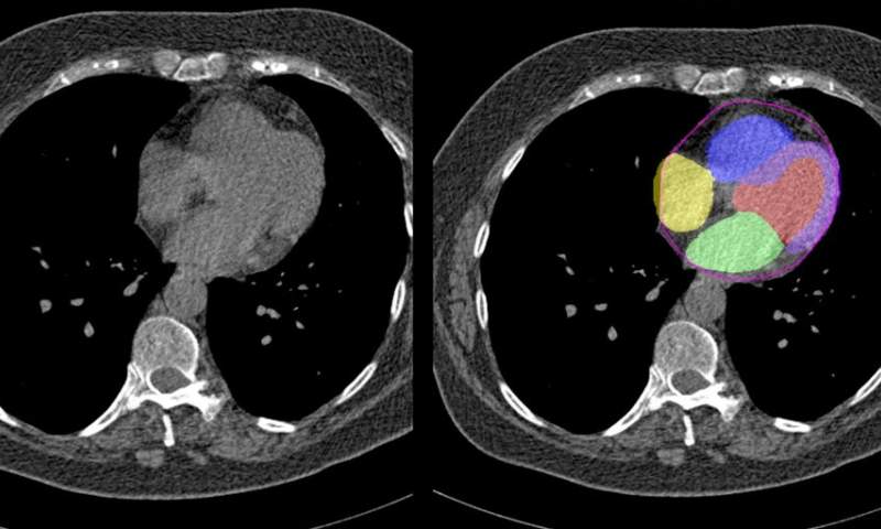Photon-counting CT improves cardiac imaging in babies • healthcare-in ...