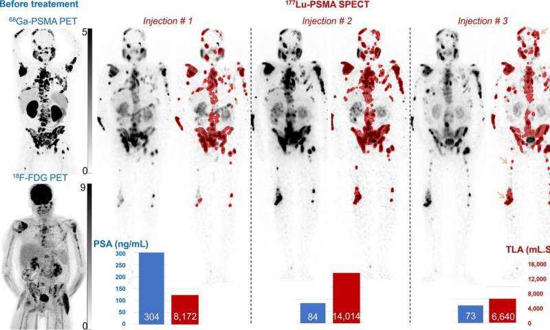 Prostate cancer: New SPECT/CT technique for greater treatment precision ...