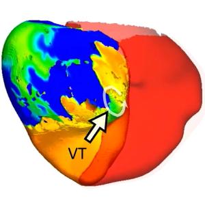 'Digital twin' hearts could help treat Atrial Fibrillation • healthcare ...