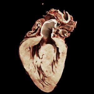 Seven-second X-ray scan detects heart complication after ToF surgery ...