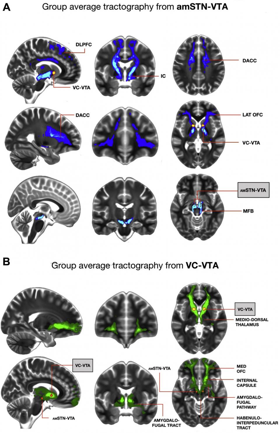 Targeted deep brain stimulation reduces OCD symptoms • healthcare-in ...