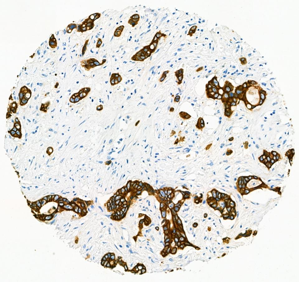 Infusing tissue micro­arrays with new, 'digital' life • healthcare-in ...