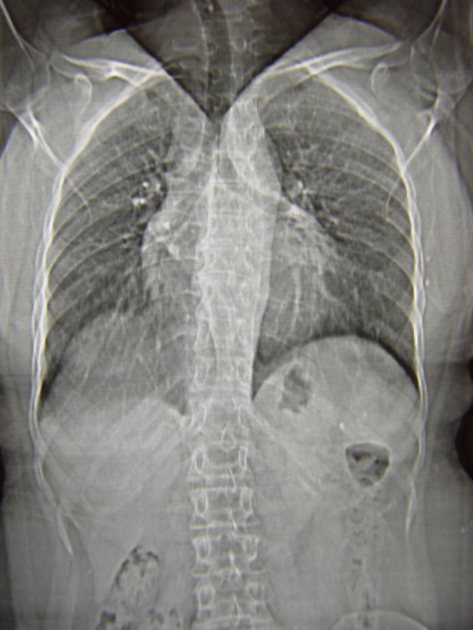 FDA approval for scleroderma treatment • healthcare-in-europe.com