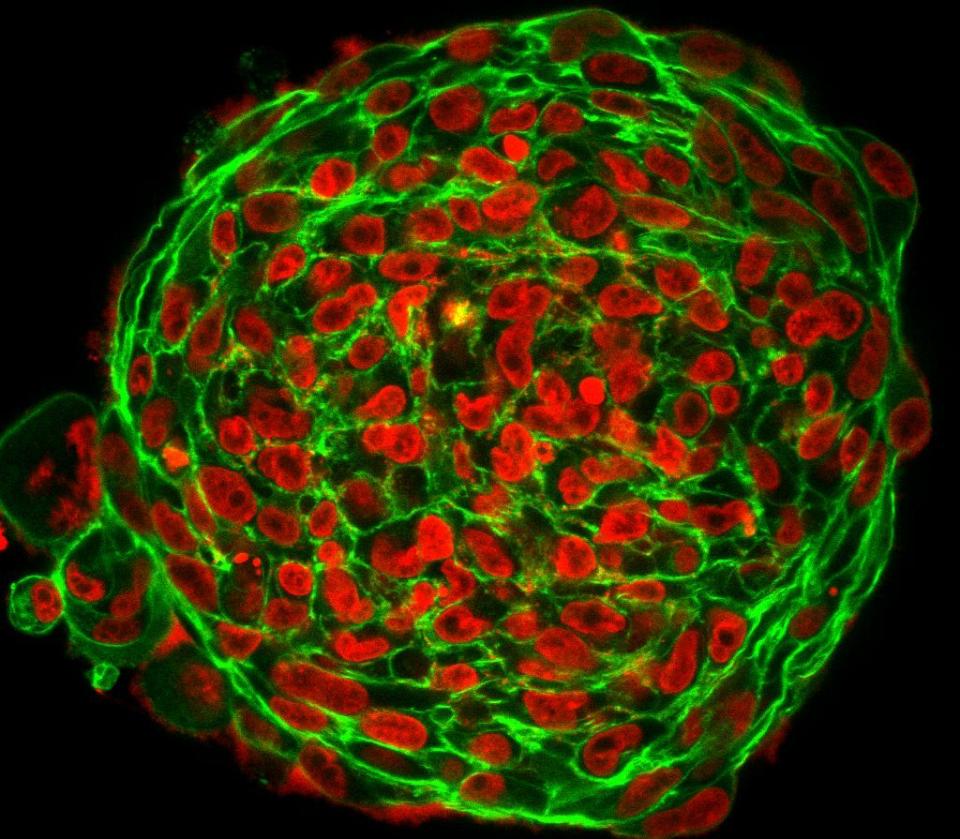 How cancer cells shape-shift to squeeze through tissue • healthcare-in ...