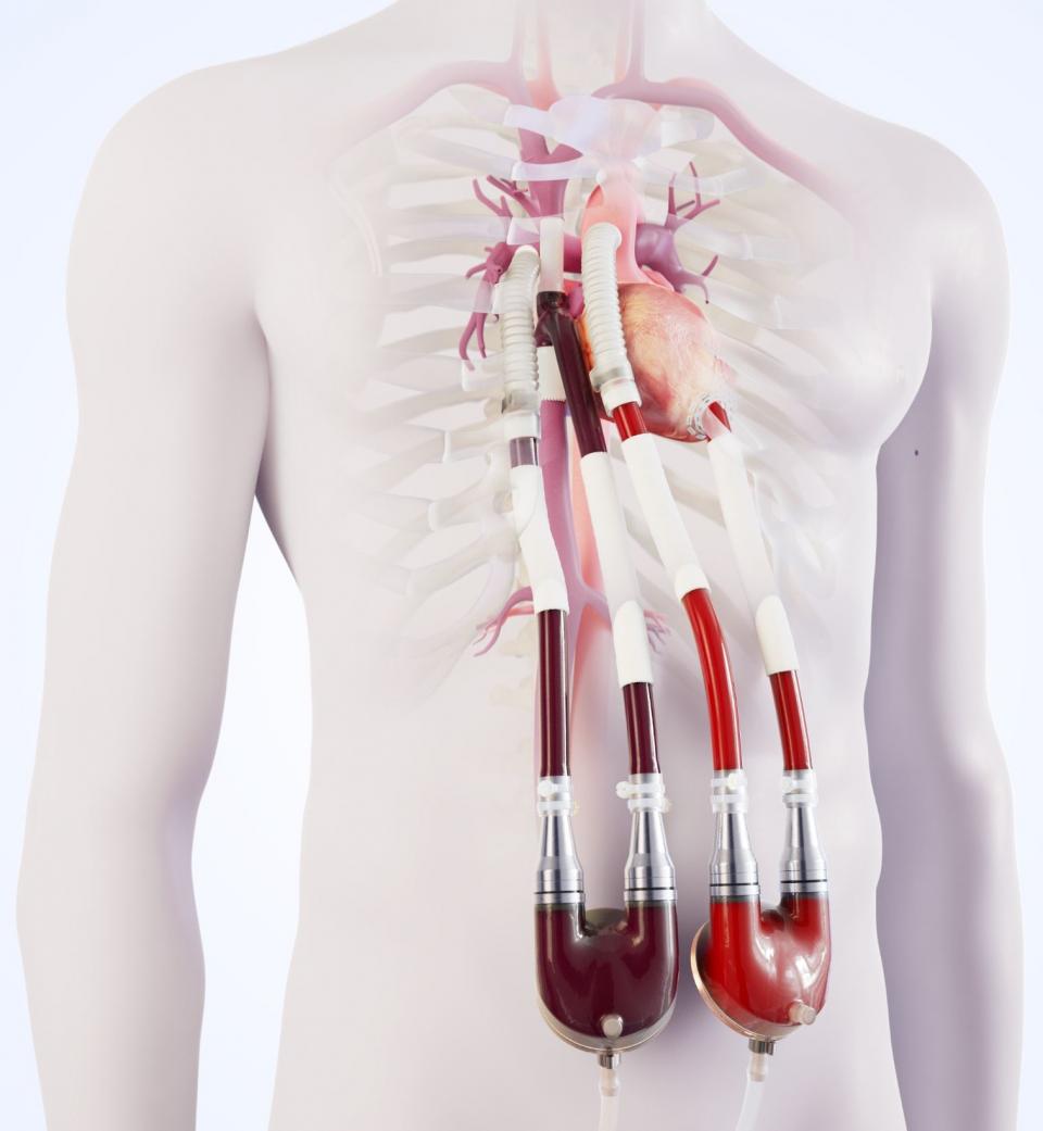 New circulation implant to bridge the waiting time for donor heart ...