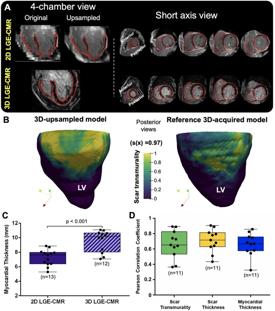 3D mapping of post-infarction scarring increases prognostic potential ...