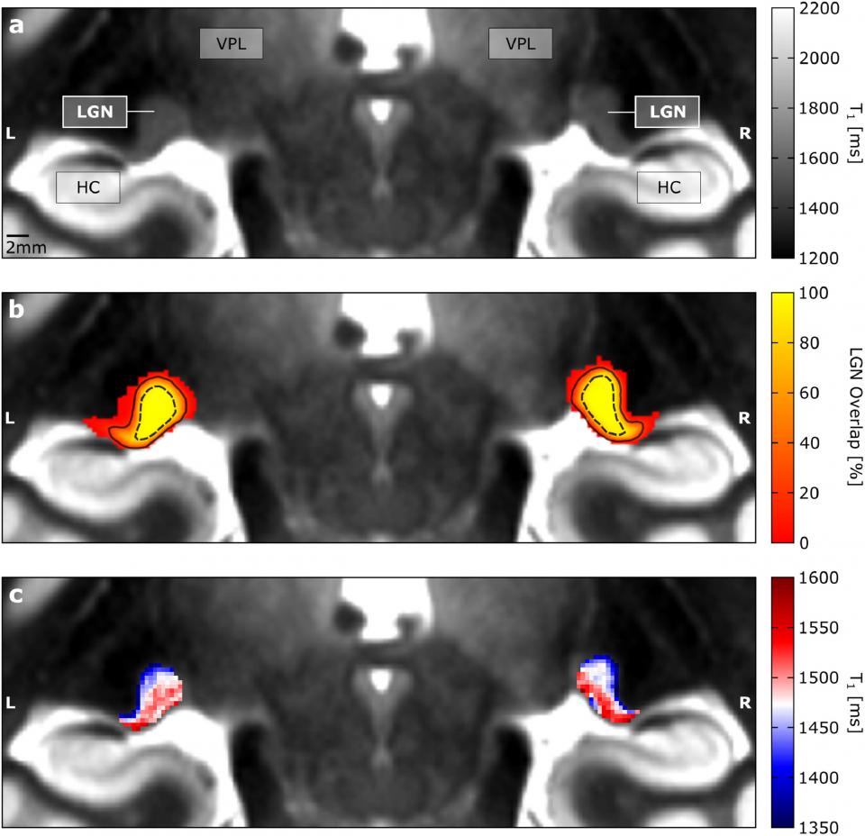 High-definition MRI reveals previously hidden territory of the human ...