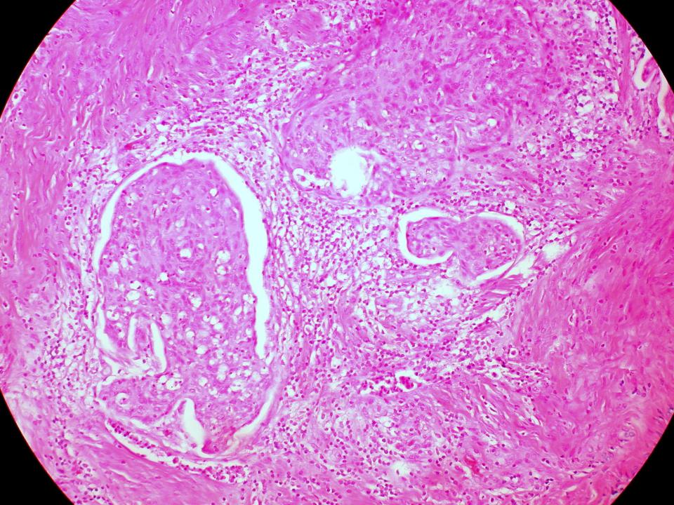 Cervical cancer: major new clue to understanding aggressiveness ...