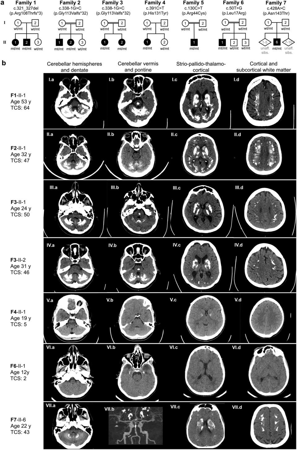 New insights on cause of brain calcification • healthcare-in-europe.com