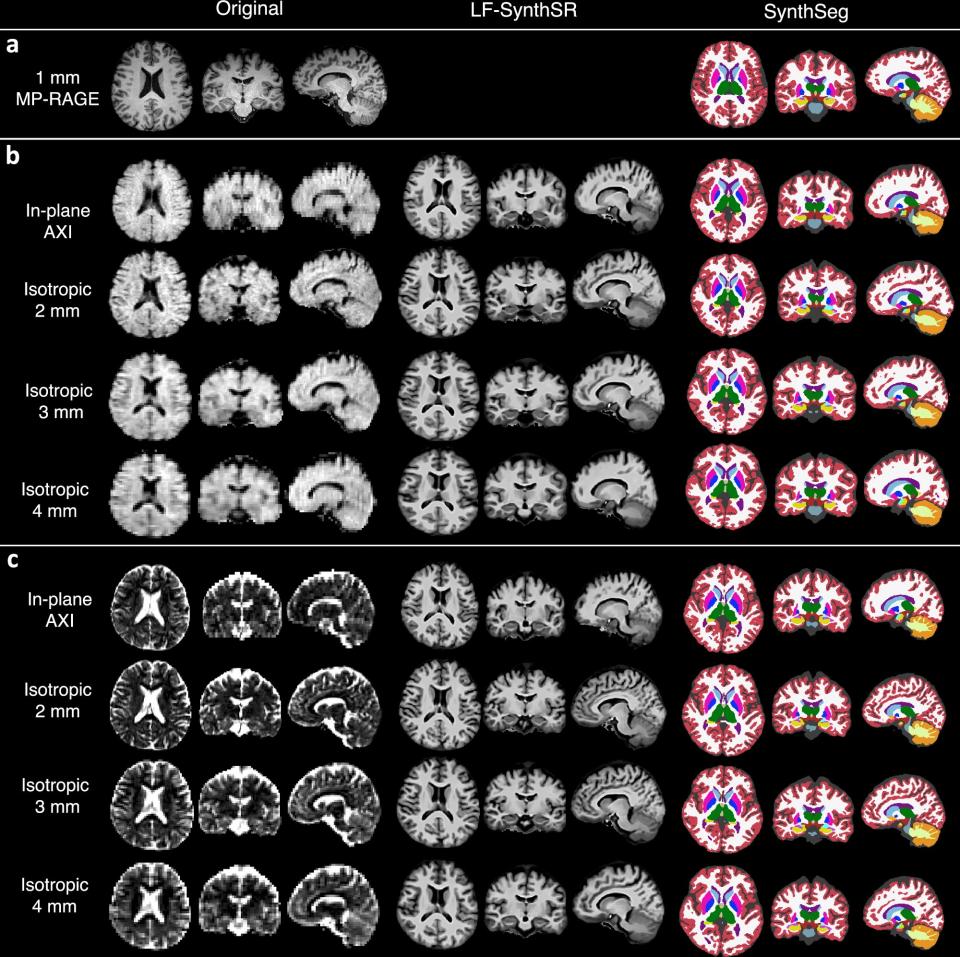Portable, low-field MRI shows promise for Alzheimer's diagnostics ...