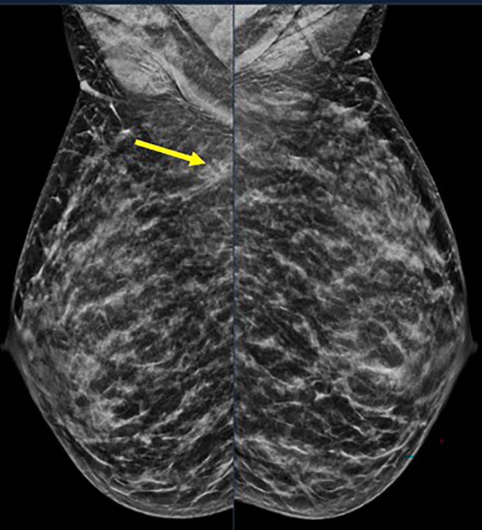Alarming number of invasive breast cancers in younger women ...