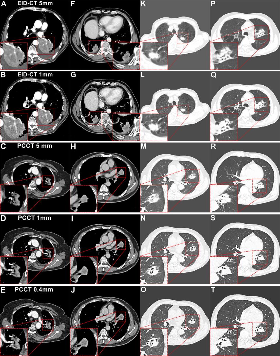 Lung cancer management: Photon-counting CT outperforms conventional CT ...