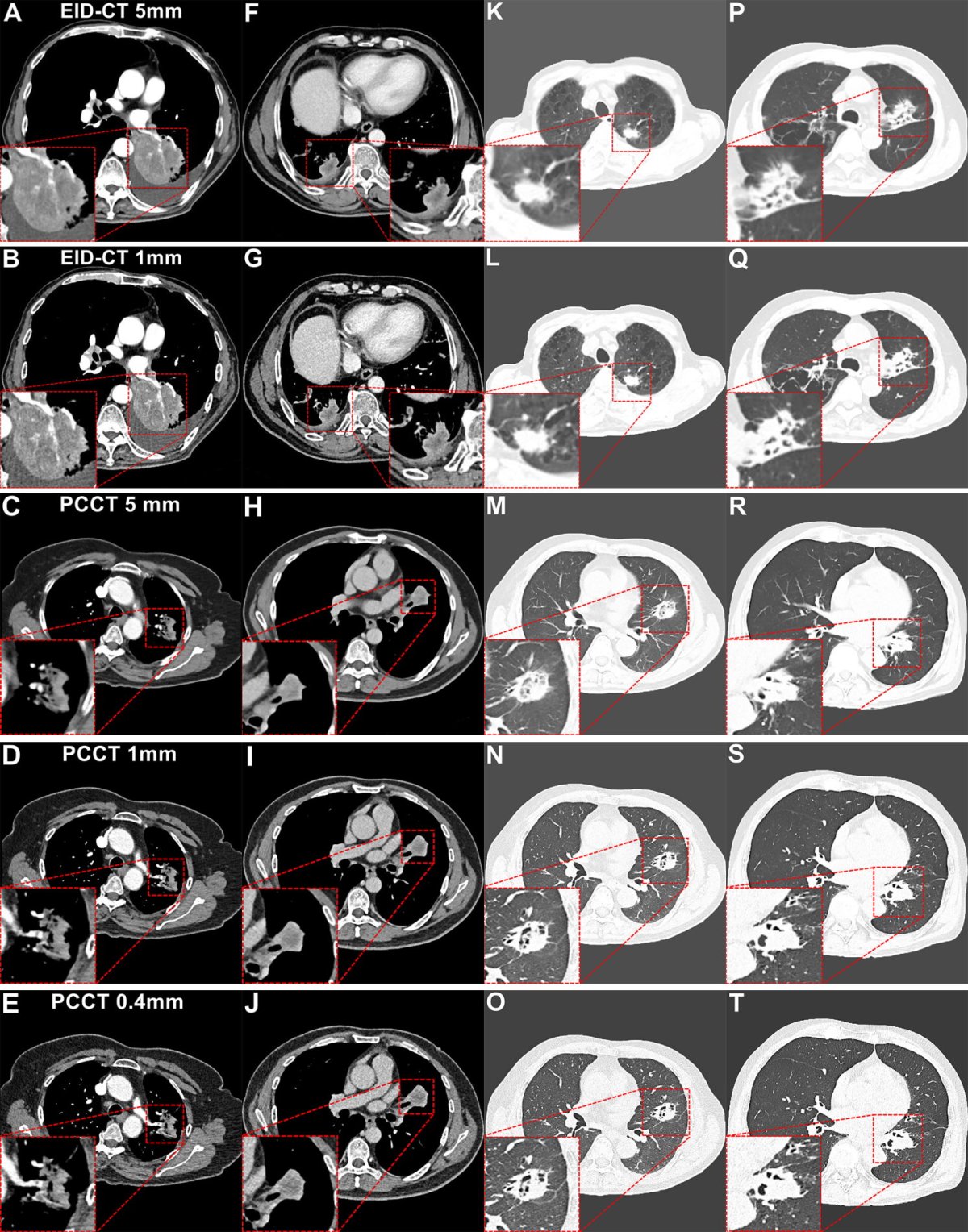 Lung cancer management: Photon-counting CT outperforms conventional CT ...