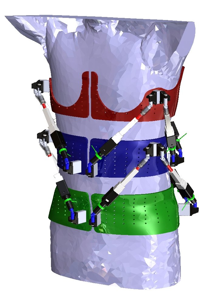 First robotic spine exoskeleton to help treat deformities • healthcare ...